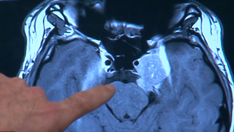 Mayfield Brain and Spine neurosurgeon using new radiation therapy | WKRC